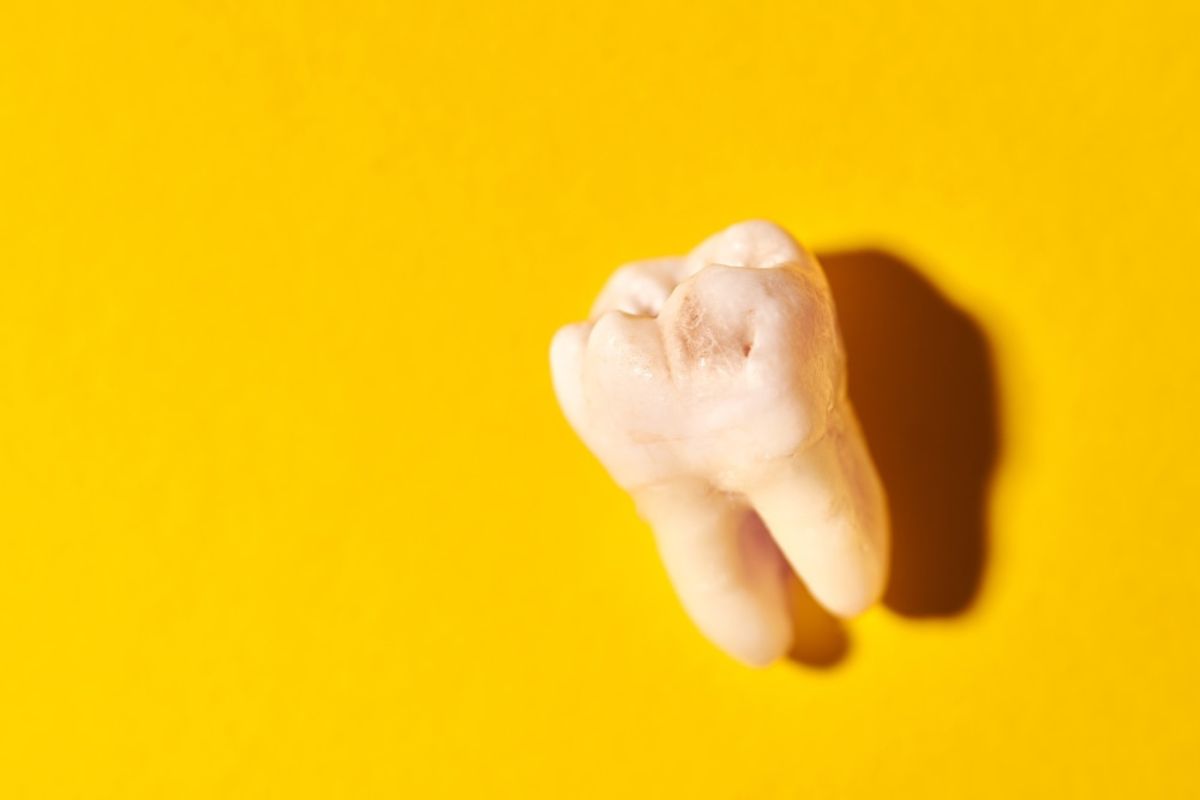 Can Wisdom Teeth Grow Back After Removal? Facts Explained