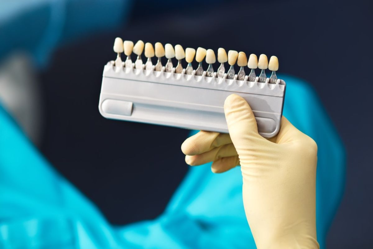 Are Dental Crowns Permanent? What You Need to Know